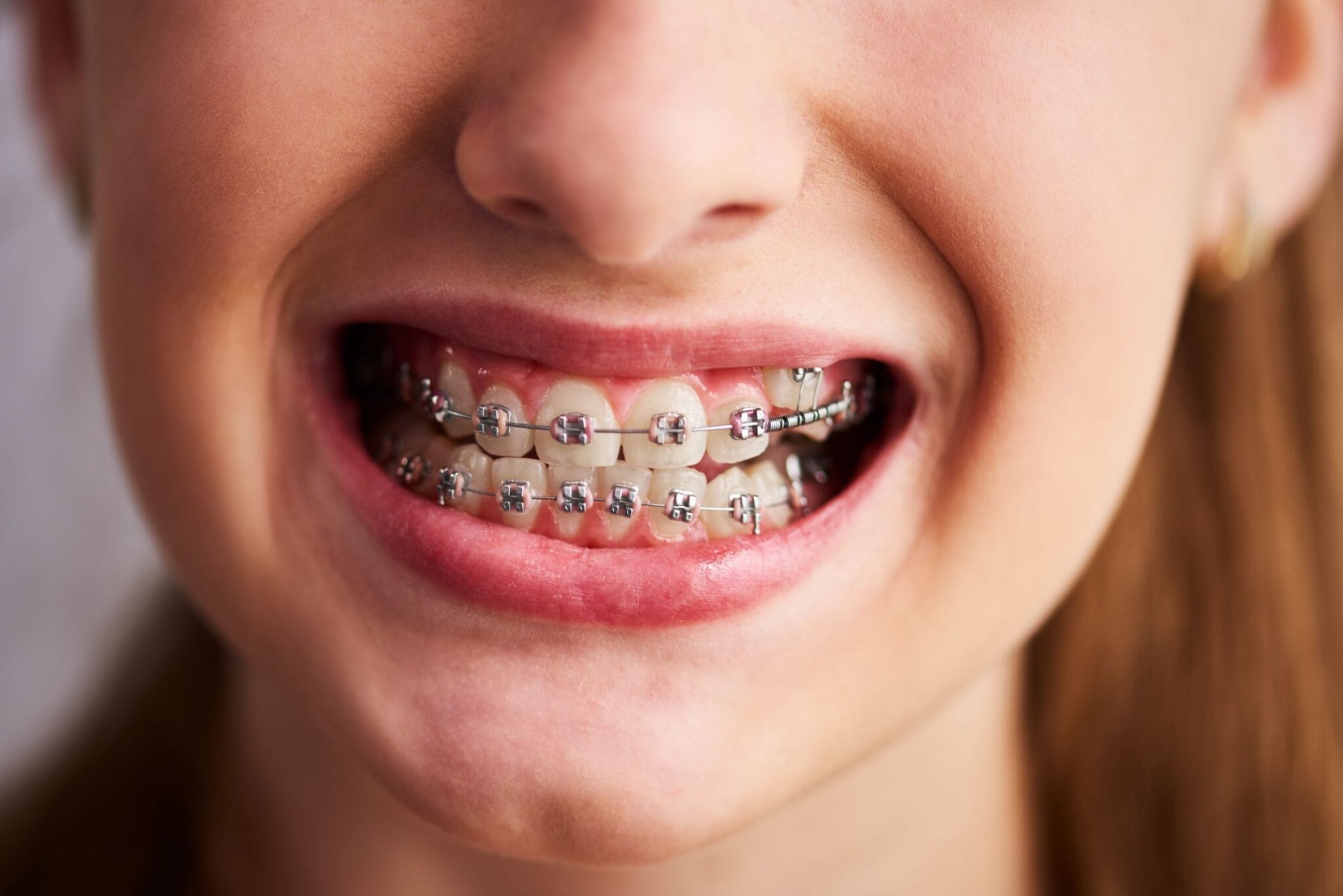 Orthodontist New Orleans, LA | Braces & Invisalign® | Bayou Braces
